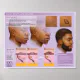 Melalogic Razor Bumps and Keloids Medical Poster | Zazzle
