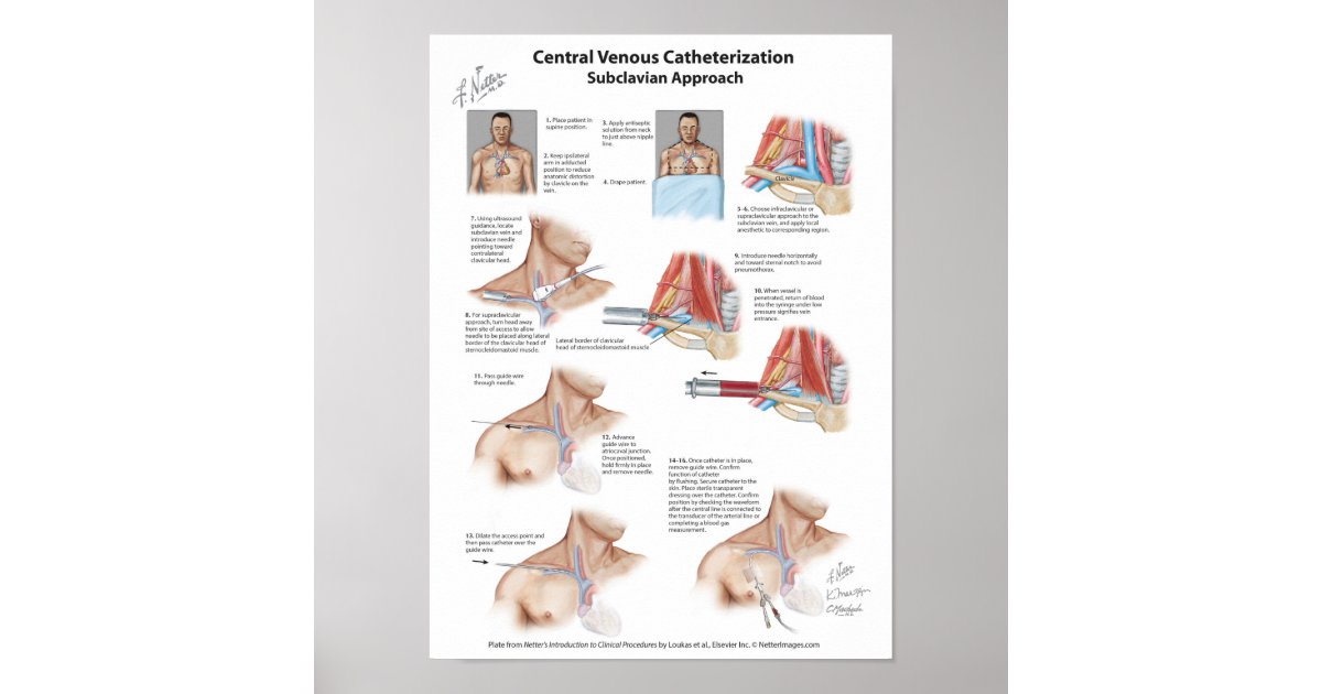 Netter Chart: Central Venous Catheterisation Poster | Zazzle