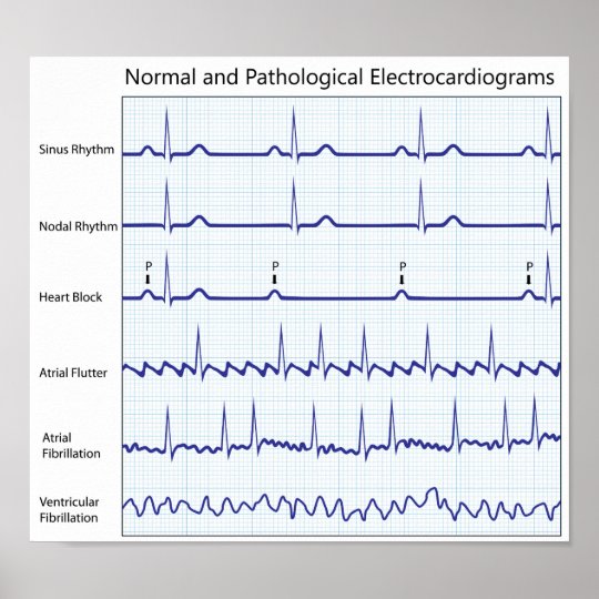 Normal and pathological ecg Poster | Zazzle.com.au