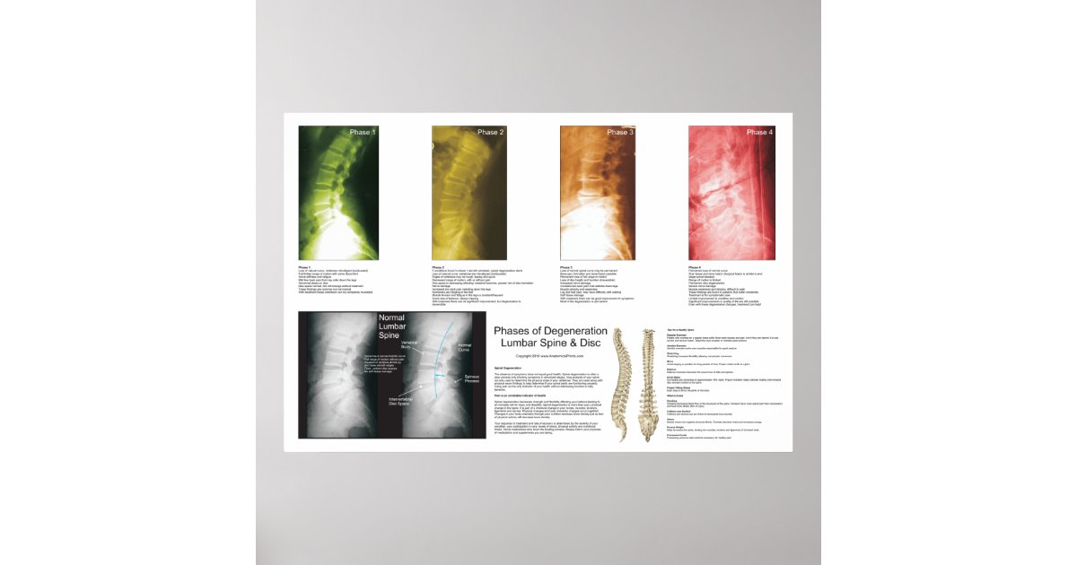 Phases Lumbar Spinal Degeneration Poster | Zazzle