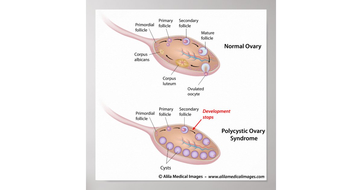 Polycystic ovary syndrome, labelled diagram. poster | Zazzle