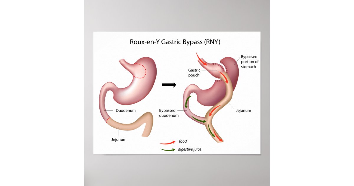 Roux-en-Y Gastric Bypass surgery poster | Zazzle